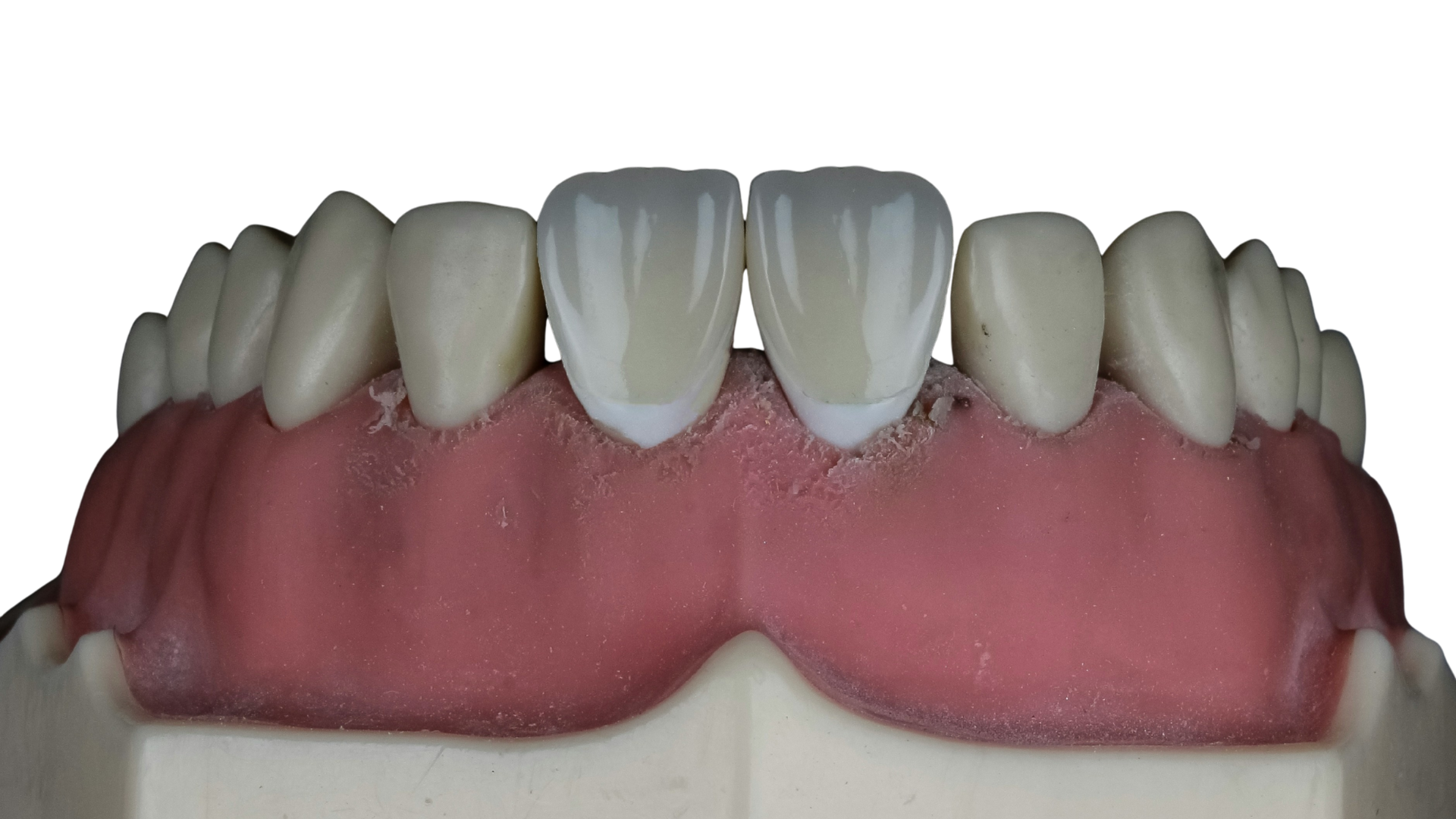 Full Arch Dental Implants in Statesville NC